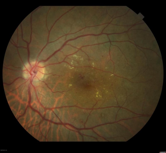 First Retinnova Congress on efficacy and safety in the treatment of ...