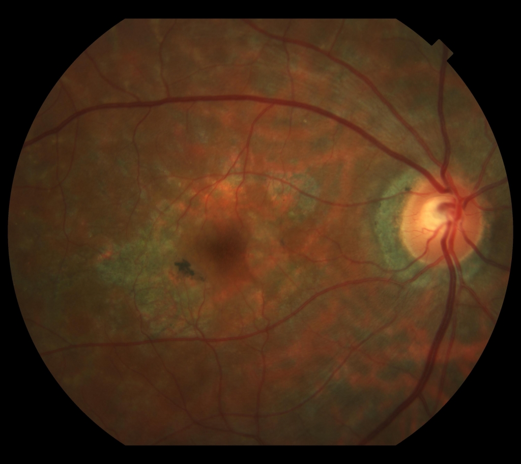 STARGARDT_color | Barcelona Macula Foundation: Research for Vision